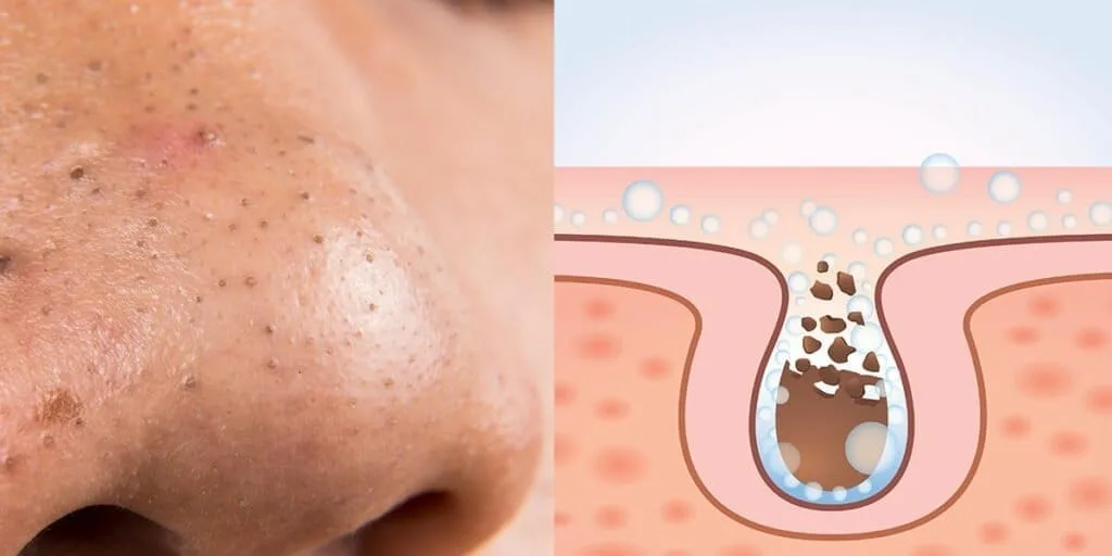 Black spots on nose store